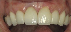 So What’s a CEREC Guide? | Off The Cusp