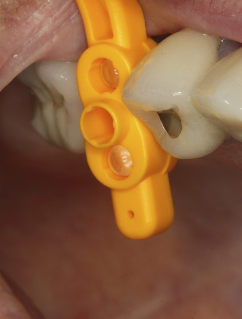 So What’s a CEREC Guide? | Off The Cusp
